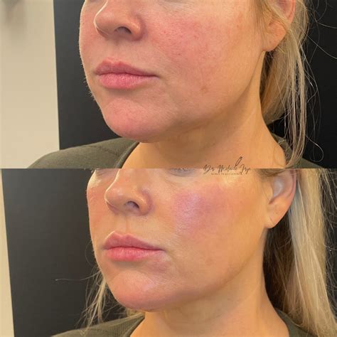 Before And After Photos Ori Aesthetics Medspa In Houston