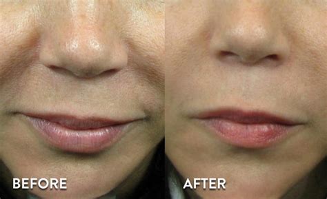Juvederm Before And After Pictures Voluma Vollure Juvederm XC