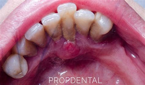 Tipos de infecciones dentales Como tratar una infección de boca