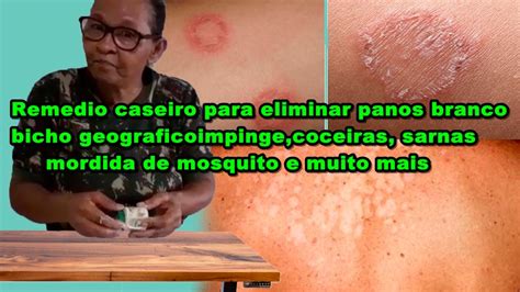 Remedio Caseiro Para Eliminar Panos Branco Bicho Geografico Impinge