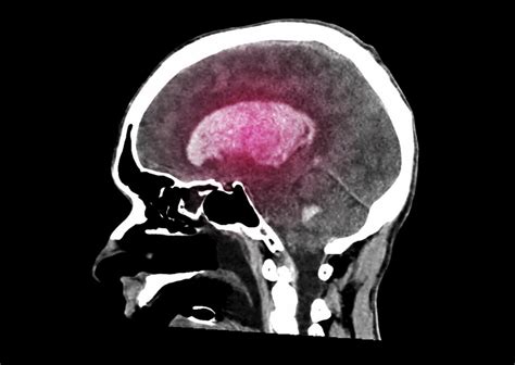Craniotomy For Hematoma Hart Garner MD Minnesota Spinal Neurosurgeon