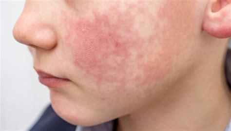 Peta bolest erythema infectiosum uzroci simptomi i liječenje