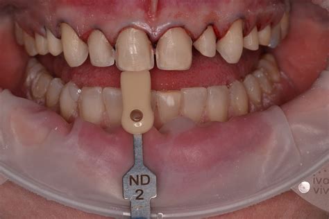 Removable Prosthodontics Implants Same Day Model Free Crowns Full