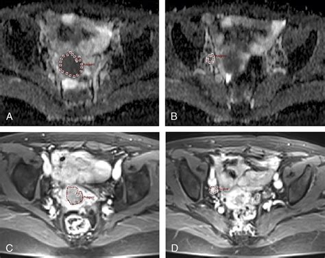 The Role Of Multiparametric Magnetic Resonance Imaging In Th