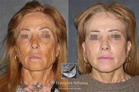 Lifting cervico facial à Lyon Dr Niforos chirurgien esthétique