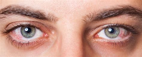 Conjuntivitis identifica sus síntomas y cómo evitarla