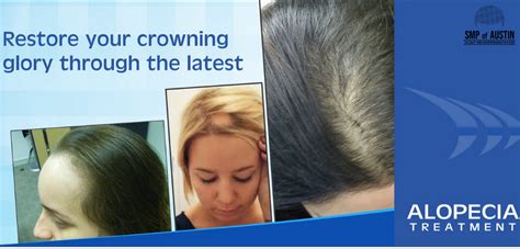 Alopecia Areata Causes Symptoms Types And Treatment Options