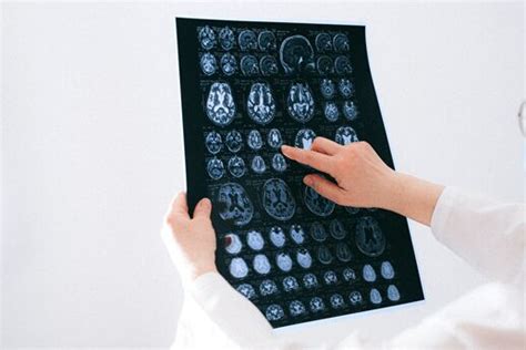 Daño Cerebral Adquirido qué es y cómo abordarlo