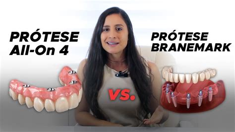 Protocolo All On 4 X Protocolo Convencional Branemark YouTube