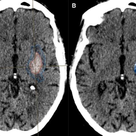 Axial Non Contrast Brain CT Scan Showing Acute Left Intracerebral