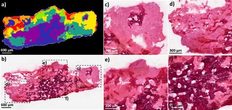 Spatial Segmentation Analysis Of Os Patient Tissue Sample From