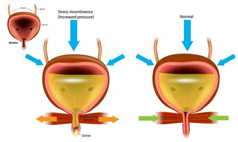 Stress Urinary Incontinence SUI Causes Diagnosis Treatment