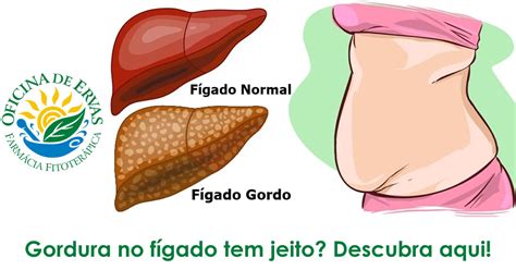 Gordura no fígado tem jeito Descubra aqui