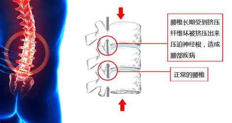 骨科专家教你，腰椎间盘突出术后如何保养健康科普健康知识福州中德骨科医院