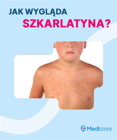 Szkarlatyna P Onica Jakie S Objawy Przyczyny I Leczenie