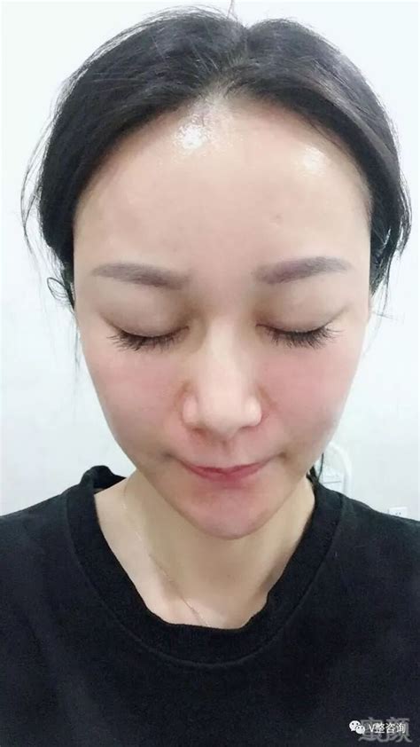 光子嫩肤让我重获好皮肤 蜜颜优惠