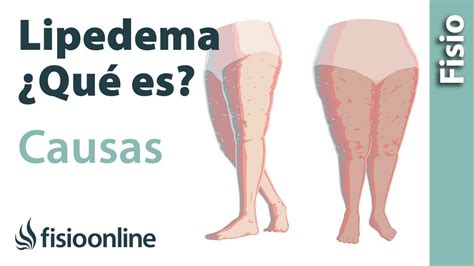 Qu Es El Lipedema Y Cu Les Son Sus Causas Fisioonline