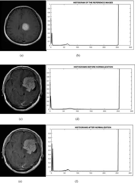 figure 3 from brain tumor segmentation using fuzzy otsu threshold morphological algorithm