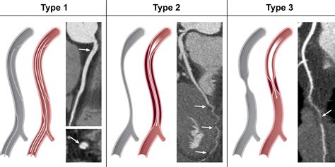 Spontaneous Coronary Artery Dissection An Underdiagnosed Clinical