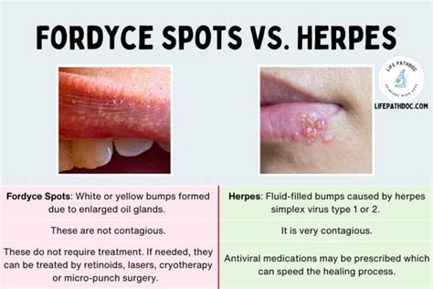 Fordyce Spots Vs Herpes Pictures And Differences