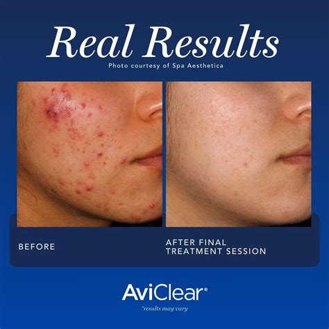 Aviclear Clinic Treatment Dorset Bournemouth Christchurch