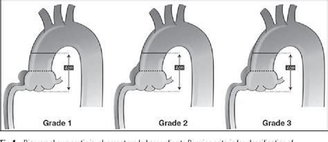 Figure 1 From Catheter Induced Aortic Dissection After Invasive