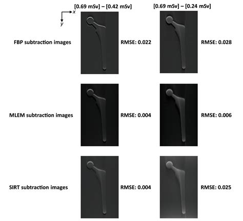 x ray digital tomosynthesis imaging — comparison of reconstruction algorithms in terms of a