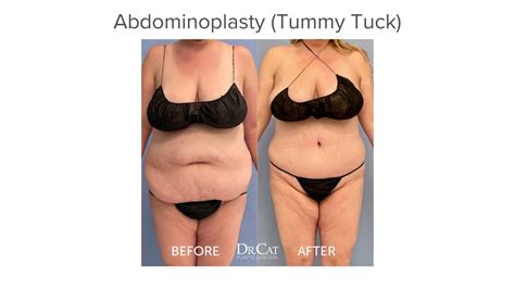 Abdominoplasty With Hernia Repair A Pubic Lift And Liposuction Of The