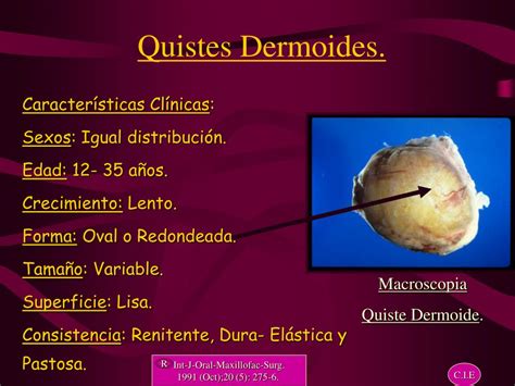 PPT Quistes Dermoides PowerPoint Presentation ID 425244