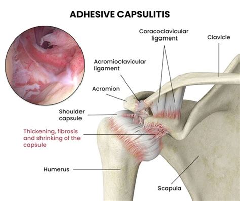 What Is A Frozen Shoulder Propel Physical Therapy