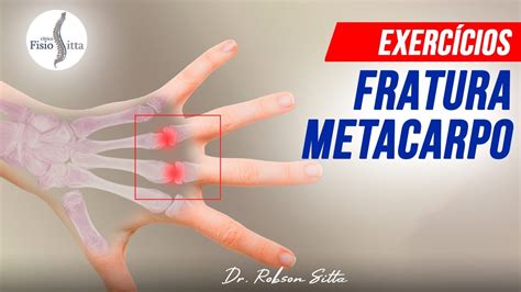 EXERCÍCIOS para FRATURA do METACARPO da MÃO MOVIMENTO dos DEDOS