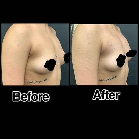 Breast Reduction Before And After Ddd