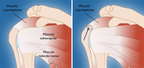Anatomia Do Manguito Rotador Origem Inser O E A O Rog Rio Souza