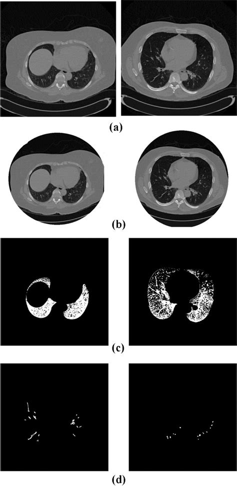 deep fuzzy segnet based lung nodule segmentation and optimized deep learning for lung cancer