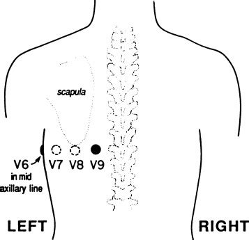 Electrocardiographic Diagnosis Of Remote Posterior Wall Myocardial