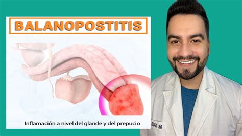 BALANOPOSTITIS TENGO INFLAMADO EL PREPUCIO Y EL GLANDE DE MI P3N3
