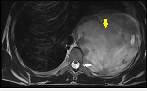 Figure 3 From A Rare Case Of Primary Pleural Neurofibroma Semantic