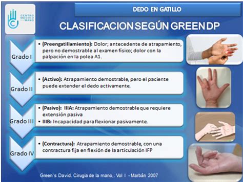 Dedo En Gatillo Cirugia Y Clasificacion Dr Abraham Marsal