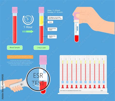 Erythrocyte Sedimentation Rate Test ESR Test Blood Diagnose
