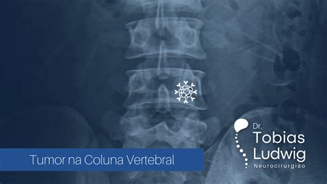 Tumor Na Coluna Dr Tobias Ludwig