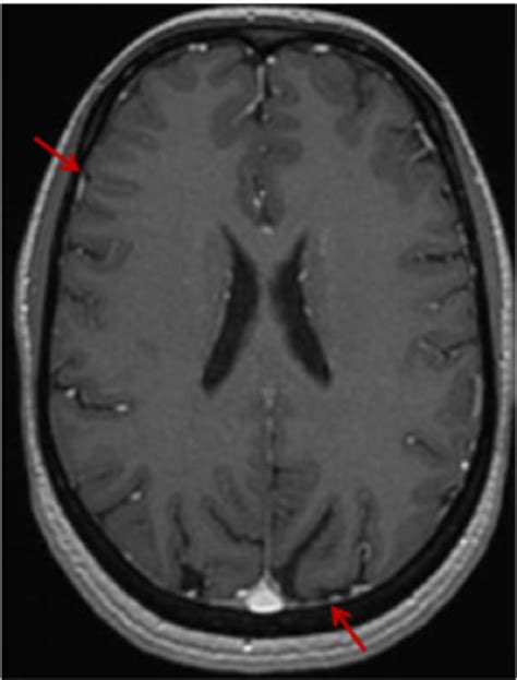 Figure 4 From Patterns Of Abnormal Meningeal Enhancement In Magnetic