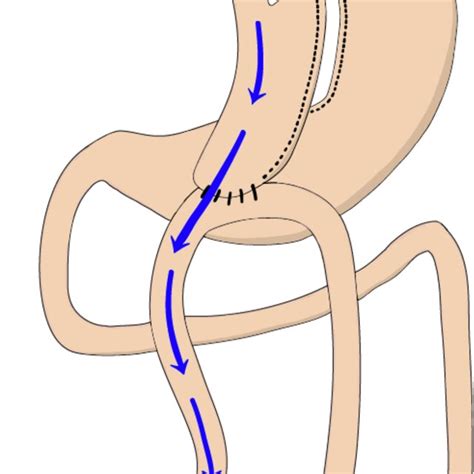 One Anastomosis Gastric Bypass OAGB OAGB Entails The Creation Of A