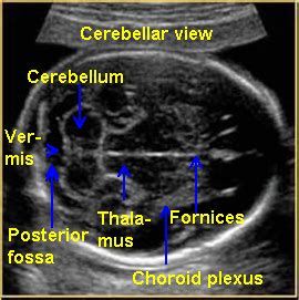 Fetal Brain Ultrasound Labeled