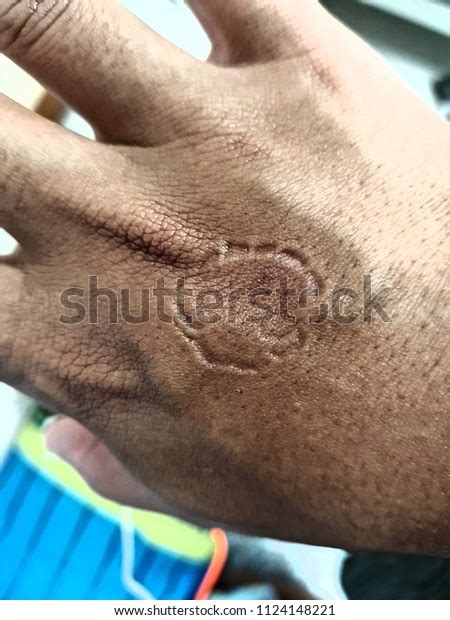 Teeth Mark Over Royalty Free Licensable Stock Photos Shutterstock