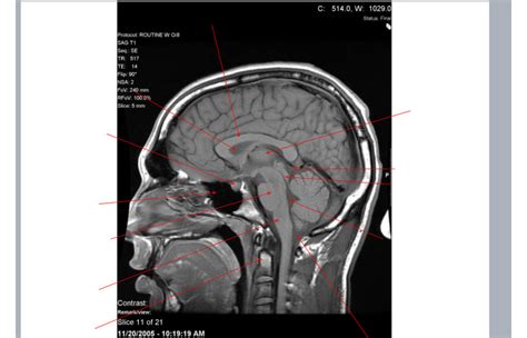 Ct Scan Brain Slice Diagram Quizlet