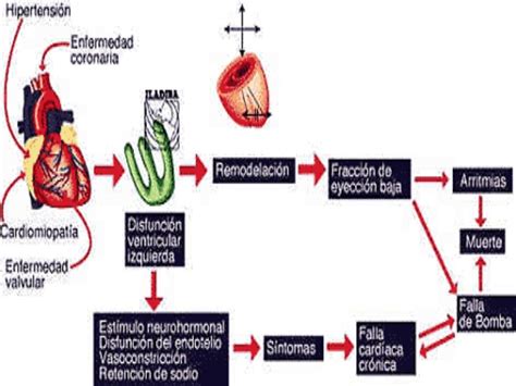 Insuficiencia Cardiaca Congestiva