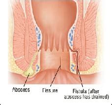 Anal Abscess And Fistula And Webmd Telegraph