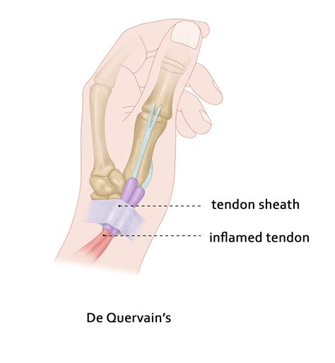 De Quervain S Tendonitis Sydney Randwick Plastic Surgery