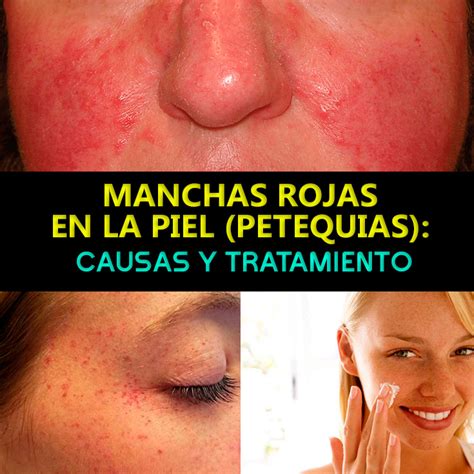 Manchas rojas en la piel petequias causas y tratamiento La Guía de