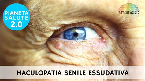 Maculopatia Senile Essudativa Sintomi E Cura Pianeta Salute Youtube